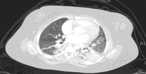 Figure2 Ct Chest Showing Atelectasis In The Left Lower Lobe Case 3 Download Scientific Diagram