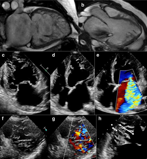 What Is Non Compaction Cardiomyopathy At Anna Tichenor Blog