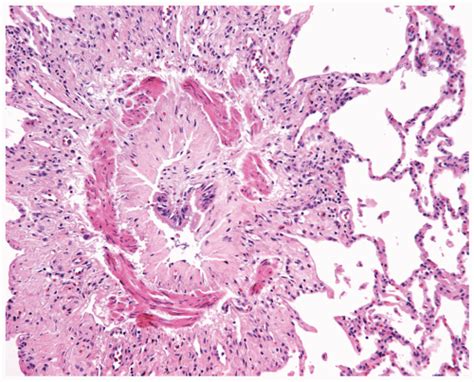 Diffuse Panbronchiolitis Basicmedical Key