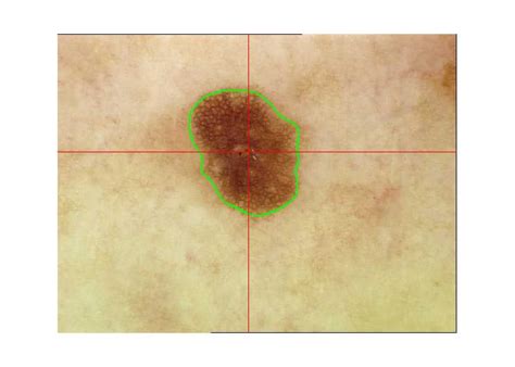 Skin Lesion Boundary Tracing Algorithm Do It Easy With Scienceprog
