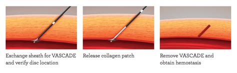 Basics Vascular Closure Devices Cardiology Apps