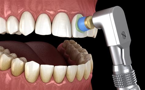 치아 연마 전문 브러시와 젤 절차입니다 의학적으로 정확한 3d 그림 검사 보기에 대한 스톡 사진 및 기타 이미지 검사 보기 디지털 생성 이미지 반짝이는 Istock