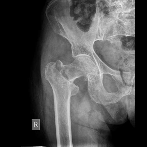 X Ray Of Femoral Neck Fracture At Ester Gordan Blog