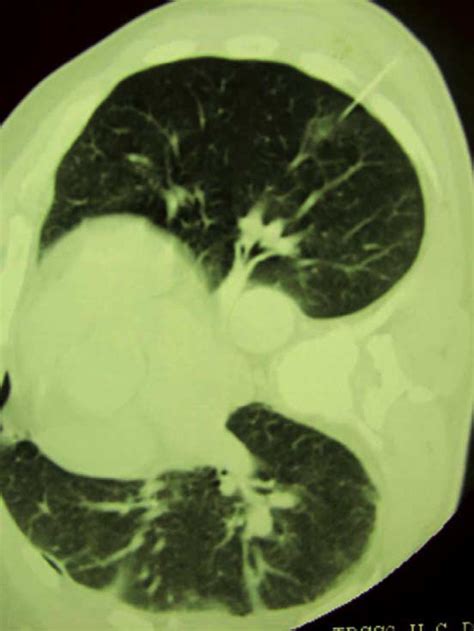 Ct Scan Shows A Pulmonary Nodule In The Left Lower Lobe The Hookwire Download Scientific