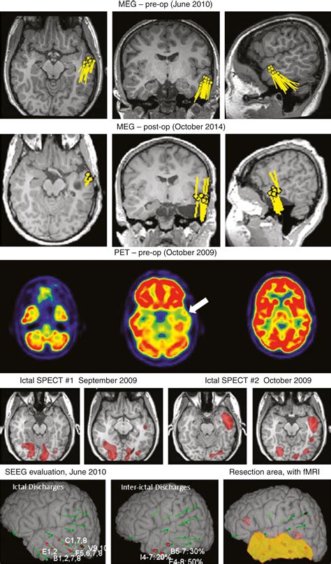 Magnetoencephalographymagnetic Source Imaging Clinical Tree
