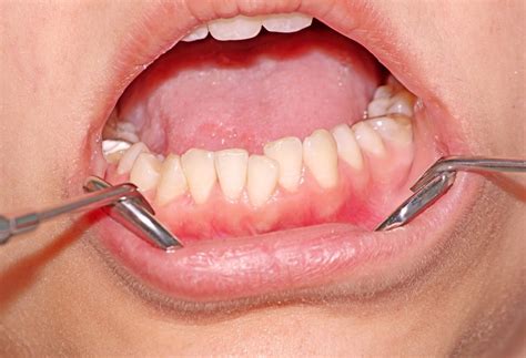 Understanding Malocclusion Causes Symptoms And Treatments Maark