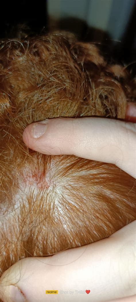 Marked Nsfw Due To Raw Looking Lesion On Scalp Is This Part Of Cfsme Marked Nsfw Due To Raw Looking Lesion On Scalp Is This Part Of Cfsme