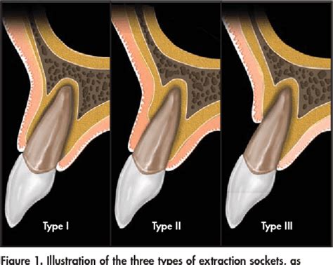 a simplified socket classification and repair technique semantic scholar