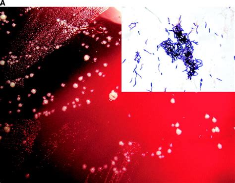 A Actinomyces Israelii “molar Tooth” Appearance On Sheep Blood Agar