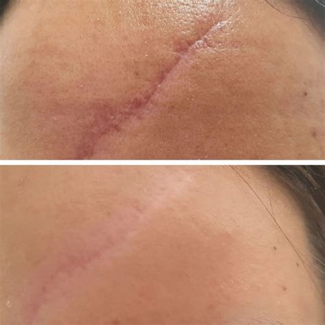 Ipl Hair Removal Keloid Scar At Cecil Messer Blog