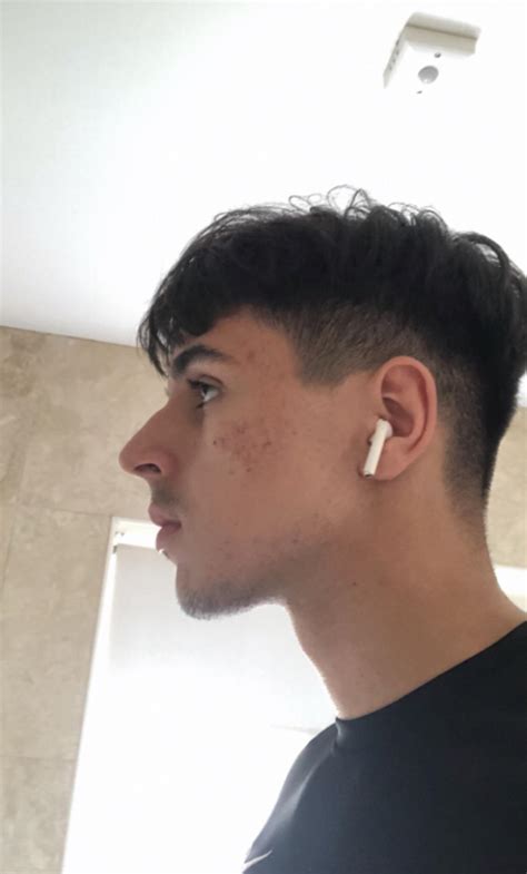 Should I Get Bimax With Ccw Or Genioplasty Rjawsurgery