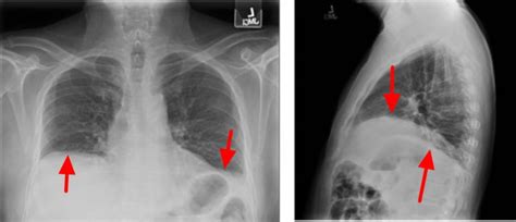 Atelectasis Causes Symptoms Atelectasis Treatment