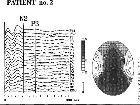 Figure 2 From P3 Recordings In Patients With Bilateral Temporal Lobe