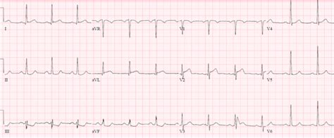 misdiagnosis from ecg lead misplacement artifact and lead reversal