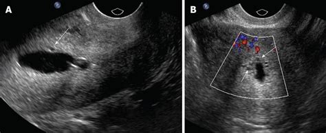 Sonohysterography Principles Technique And Role In Diagnosis Of Endometrial Pathology