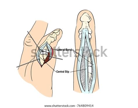 Approach Proximal Interphalangeal Joint Surgery Plain Stock Illustration Shutterstock