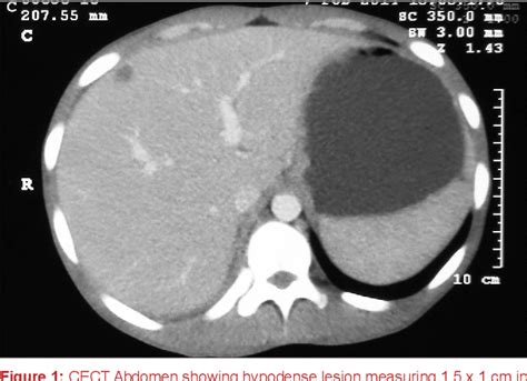 Figure 1 From Primitive Neuroectodermal Tumor In A Mixed Germ Cell Tumor A Rare Case Report