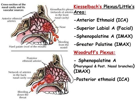 Ppt Epistaxis Powerpoint Presentation Free Download Id 9401397