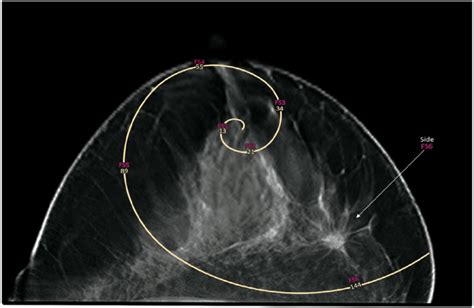 Golden Ratio Φ Breast Cancer Detection And Fibonacci Sequence