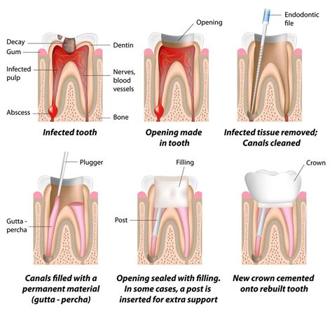 Root Canal Treatment Healthdirect