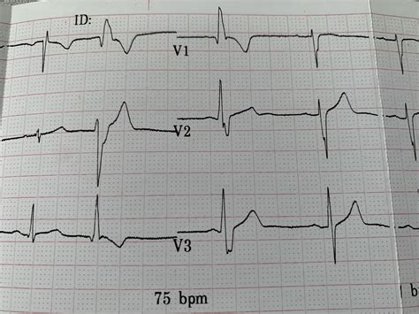 Pvc Location R Readmyecg