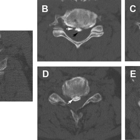 A The ‘double Layer Sign Dls Axial Ct Showing Two Anterior White Download Scientific