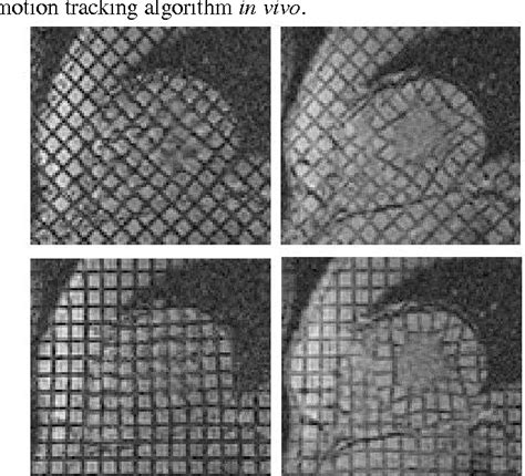 Figure 1 From In Vivo Validation Of 4 D B Spline Based Motion Tracking