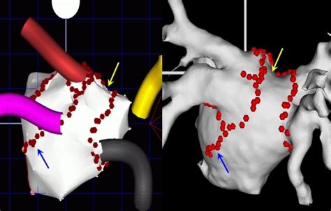 The Electroanatomic Map Of The Left Atrium Using Carto Left Can Be Download Scientific