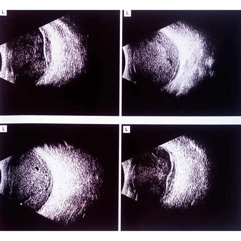 B Scan Cross Sectional Imaging Of The Eye And Orbit