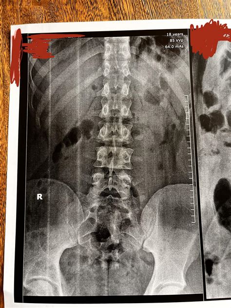 Is This Curvature Normal Rxrays