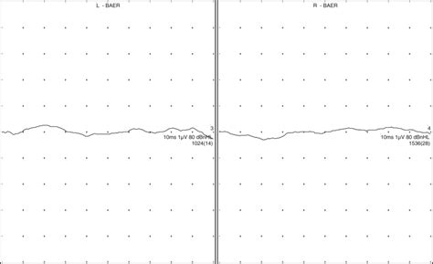 Brainstem Auditory Evoked Response From A Bilaterally Deaf Kitten