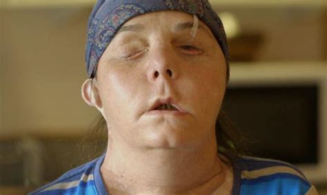 Carmen Tarleton Biography A Person Who Has Had A Face Transplant