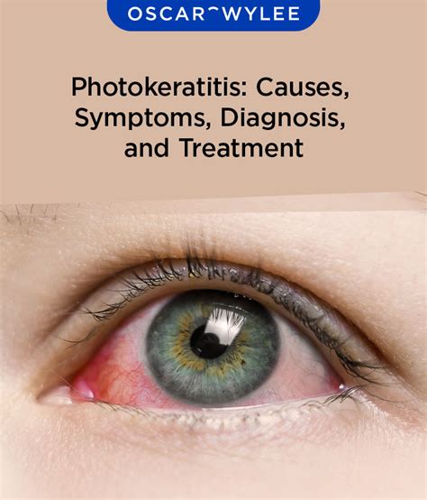 Photokeratitis Causes Symptoms Diagnosis And Treatment