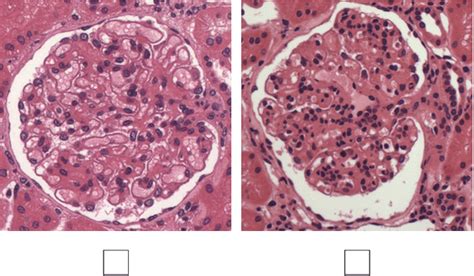 classification of glomerular hypercellularity using convolutional