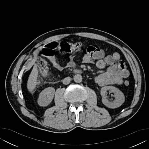 Acute Appendicitis In Subhepatic Location Eurorad
