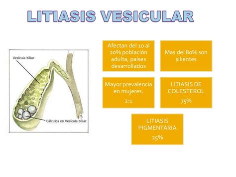 Litiasis Vesicular