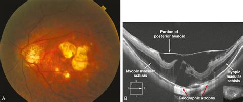 Myopic Macular Schisis Clinical Tree