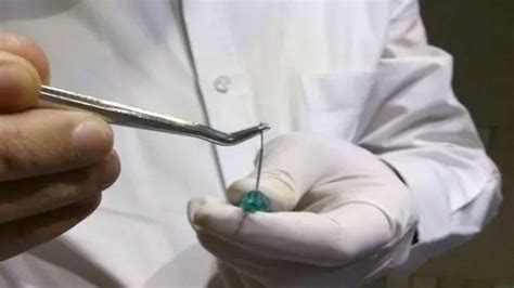 لاغری با امبدینگ چیست؟ قیمت امبدینگ عوارض امبدینگ شکم 1402