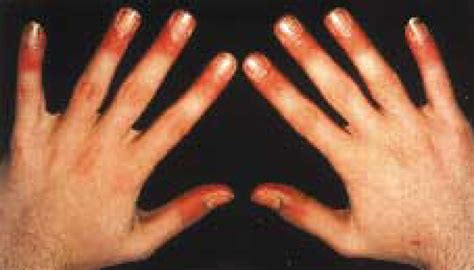 Hiv Rash On Fingers