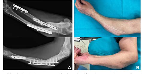Figure 1 From Forearm Segmental Bone Defect Successful Management