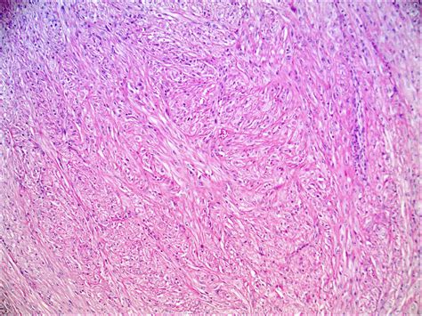 Histologia Do Angiofibroma Juvenile Angiofibroma Histology And