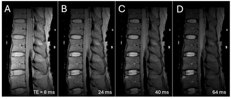 Segment Anything Model Sam And Medical Sam Medsam For Lumbar Spine Mri