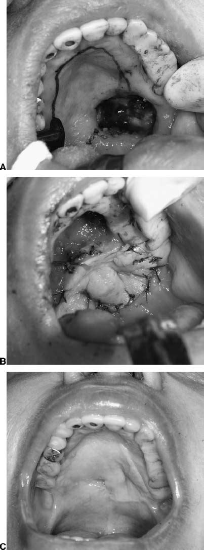 Temporal Bone Resection Ento Key