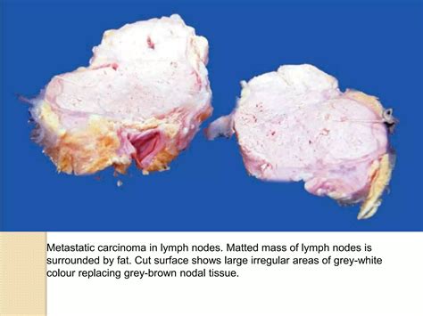 Histopathology Slides Of Pptx Cancer Diseases And Conditions Histopathology Slides Of Pptx Cancer Diseases And Conditions