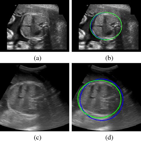 Figure 6 From Hybrid Approach For Automatic Segmentation Of Fetal Abdomen From Ultrasound Images