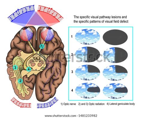 Patterns Visual Field Defect Which Represent Stock Illustration 1481233982 Shutterstock