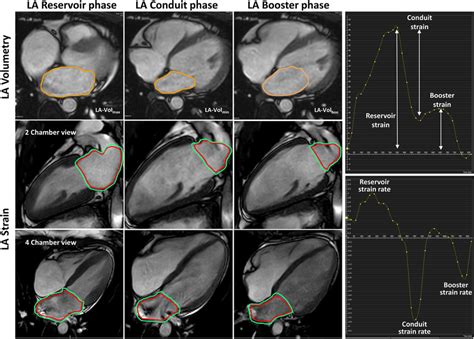 Measurement Of Left Atrial Longitudinal Strain And Strain Rate In A Download Scientific Diagram