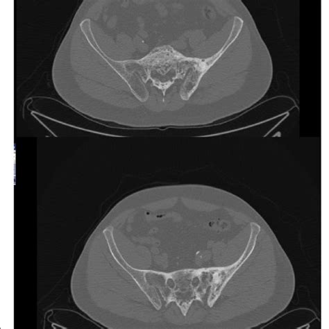 CTscan Of Pelvis A CT Scan Of The Pelvis Of The Patient Reveals That Download Scientific