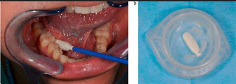 Non Invasive Diagnostic Tools For Early Oral Or Mouth Cancer Detection