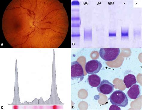 Waldenström Macroglobulinaemia The Lancet Oncology
